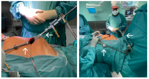 GoldLine surgical retractor system in cardiothoracic surgery - Condor ...