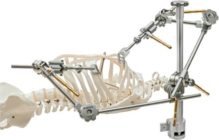 GoldLine surgical retractor system in cardiothoracic surgery - Condor ...